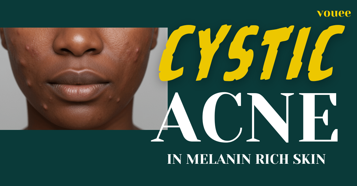 Cystic Acne on Black Skin 2025: Safe Treatments & PIH Prevention ...